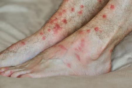 10 tip halau agas dari rumah dan cara hilangkan gatal akibat gigitannya ...